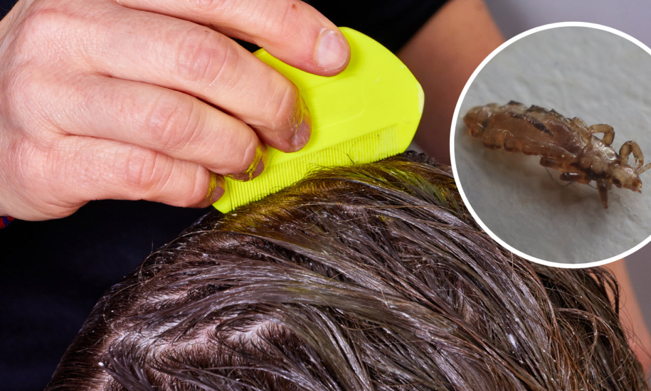How To Get Rid Of Head Lice So They Never Come Back Again – CoolerPress
