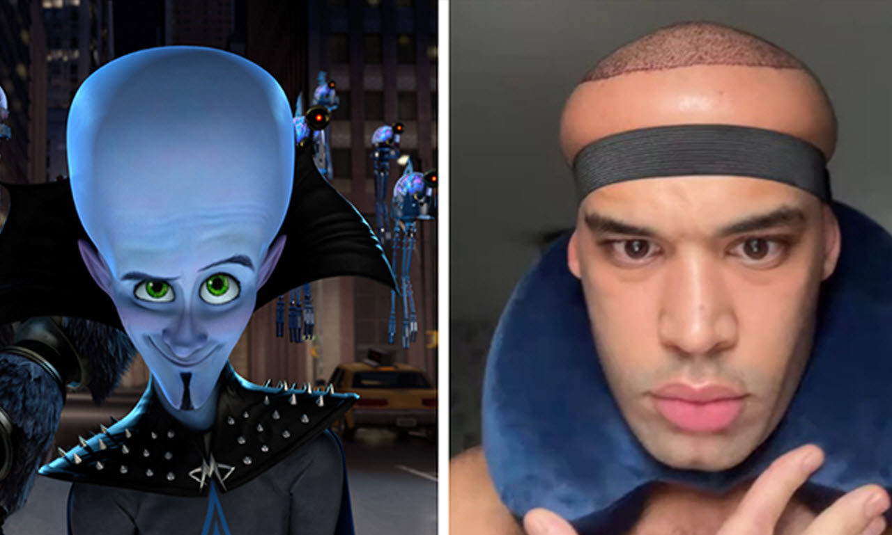 Man Gets Hair Transplant And Now He Looks Like Megamind – CoolerPress