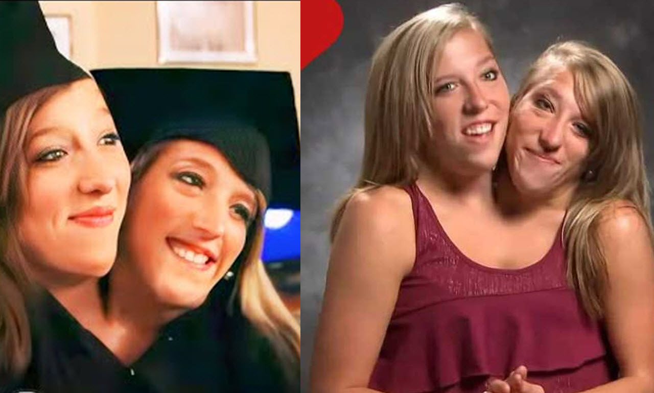 Conjoined Twins Pay For 2 At University And Then Make A Salary For One ...
